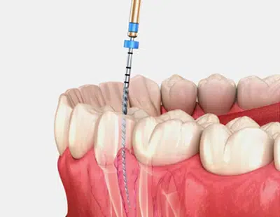 Restorative Dentist York, SC | White Rose Dentistry